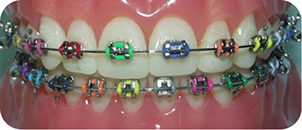 Middleton Orthodontics | Types of Braces